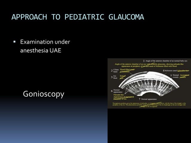 Approach to pediatric glaucoma | PPTX | Eye and Vision Conditions ...