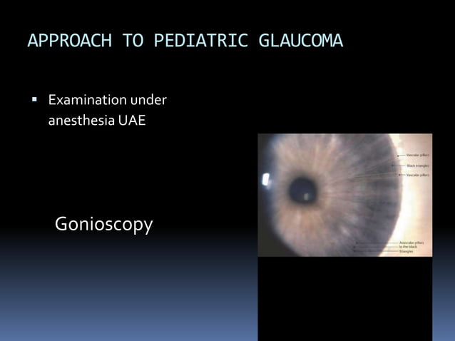 Approach to pediatric glaucoma | PPTX | Eye and Vision Conditions ...