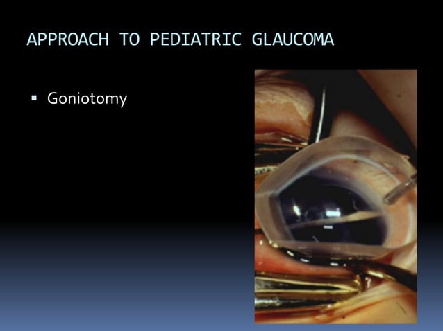 Approach to pediatric glaucoma | PPTX | Eye and Vision Conditions ...
