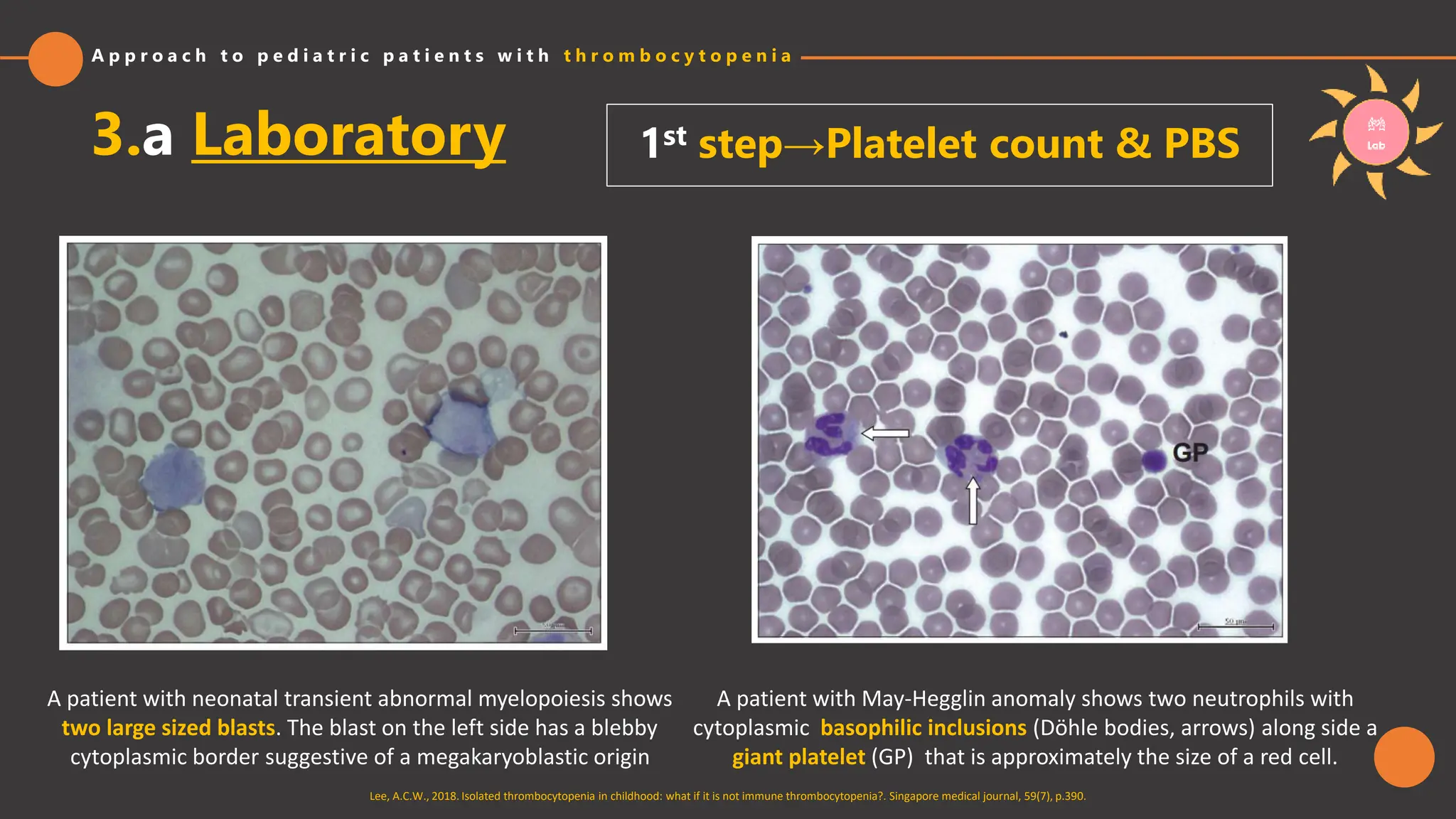 Approach to Pediatric patient with thrombocytopenia.pptx