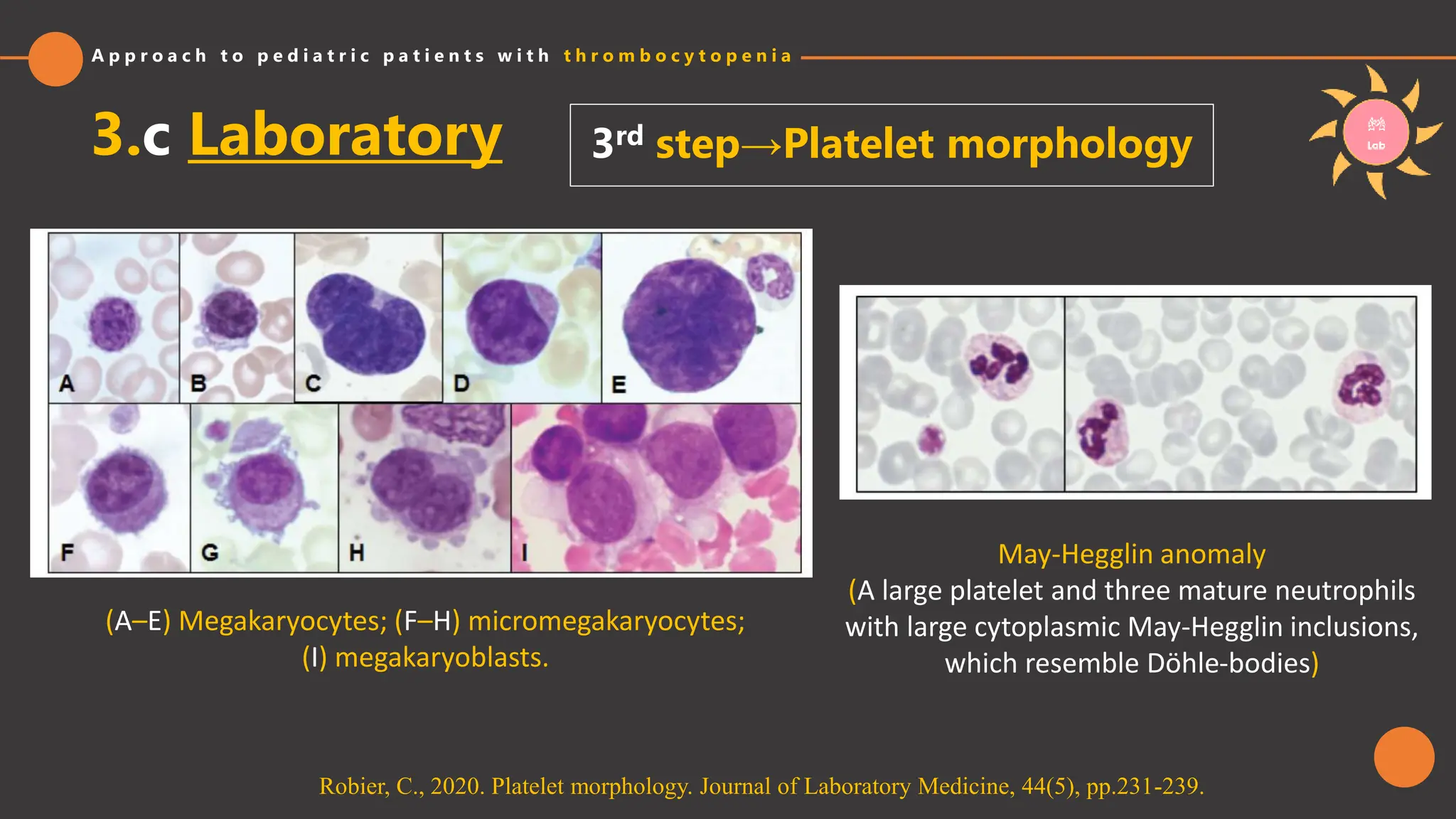 Approach to Pediatric patient with thrombocytopenia.pptx
