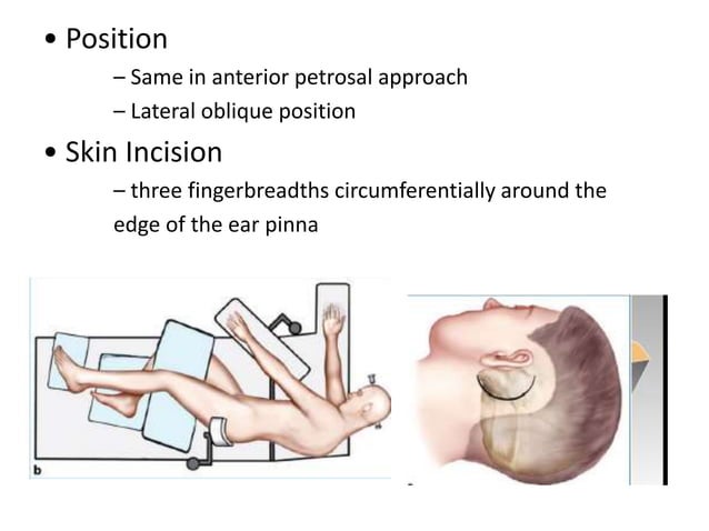 Approach to petroclival meningioma | PPTX