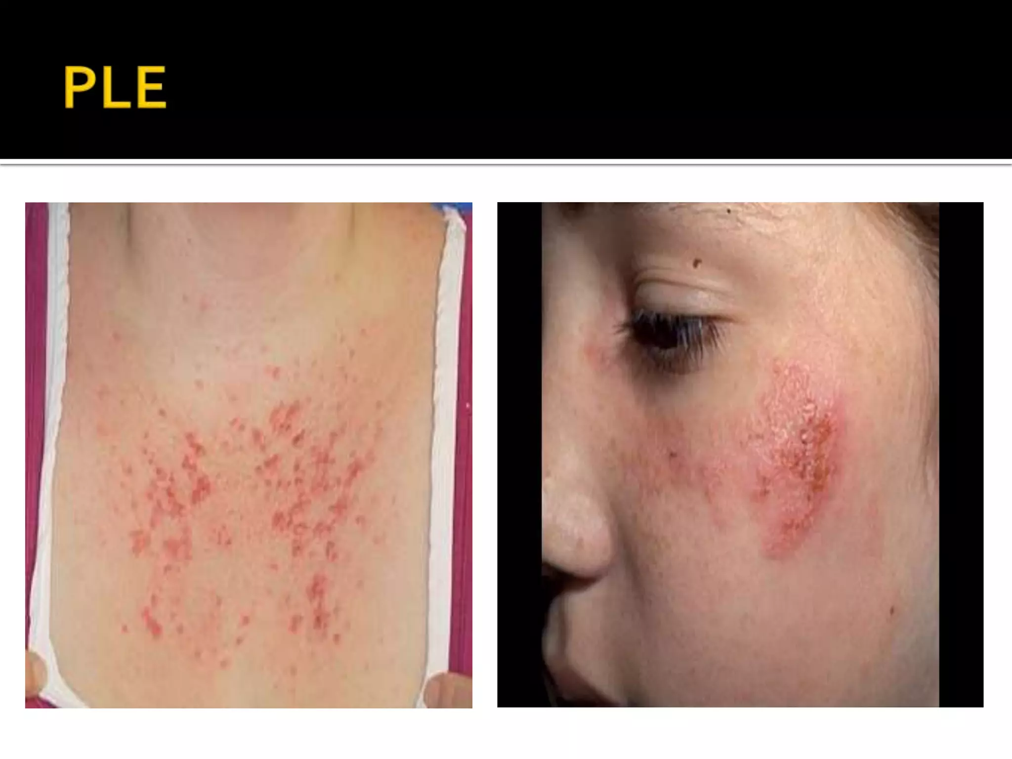 Approach to photodermatoses | PPTX