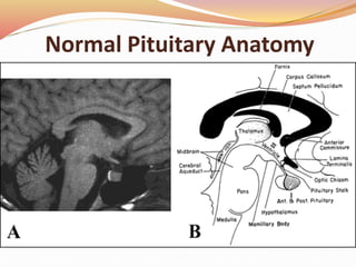 Approach to pituitary_tumours | PPTX