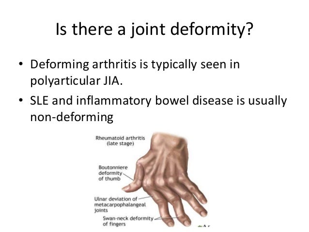 Approach to polyarthritis in children