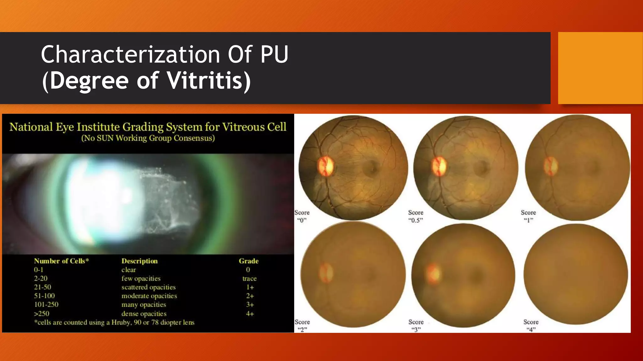 Approach to posterior uveitis final modified | PPTX