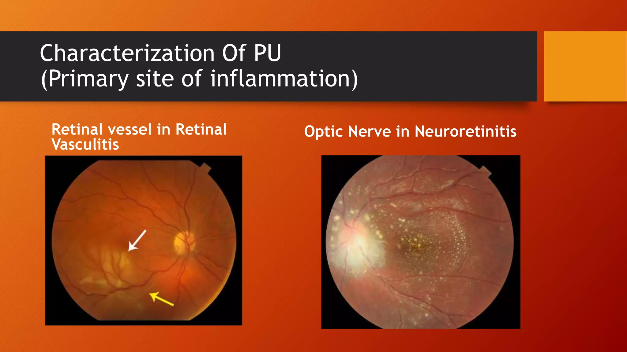 Approach to posterior uveitis final modified | PPTX