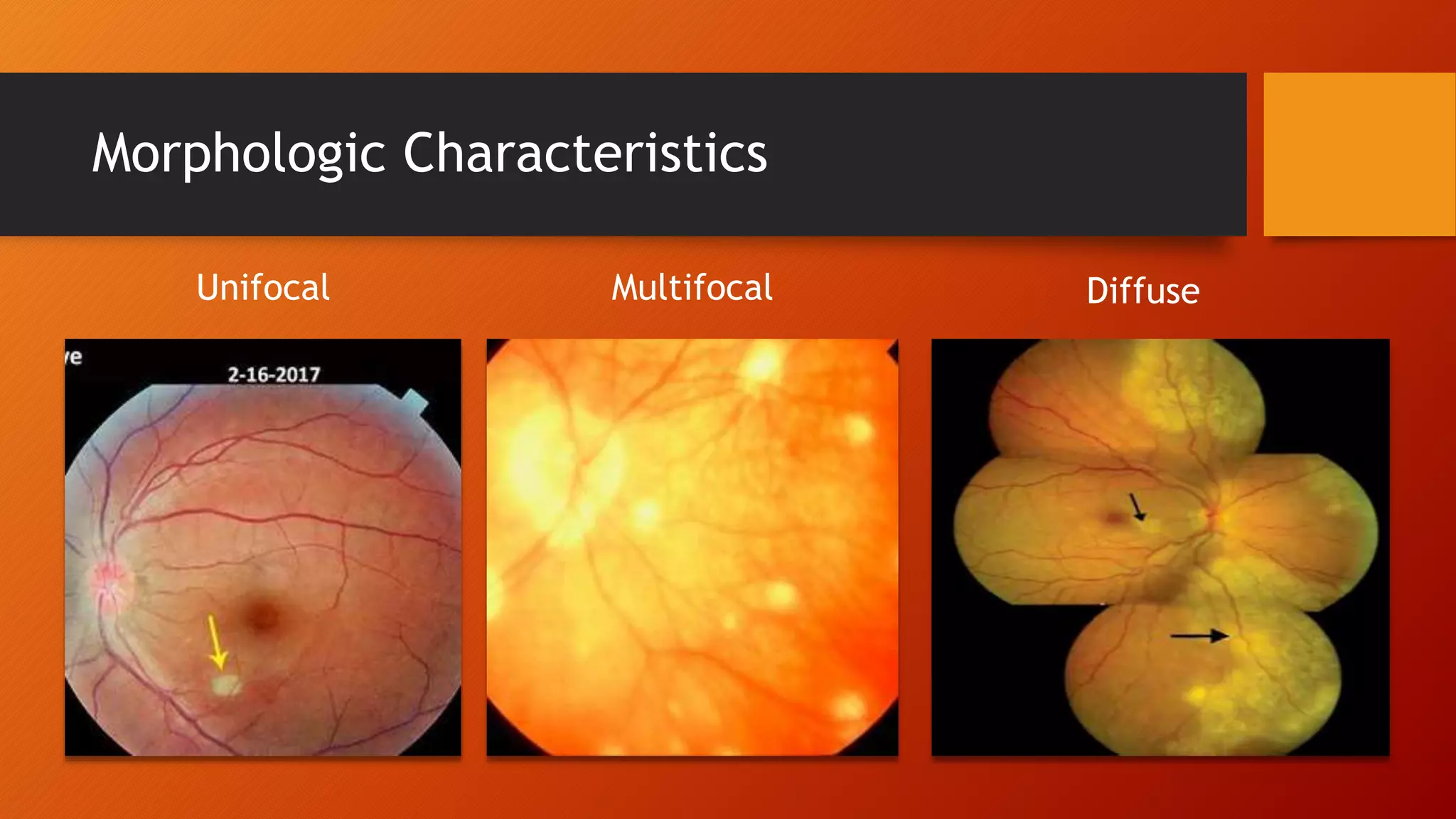 Approach to posterior uveitis final modified | PPTX