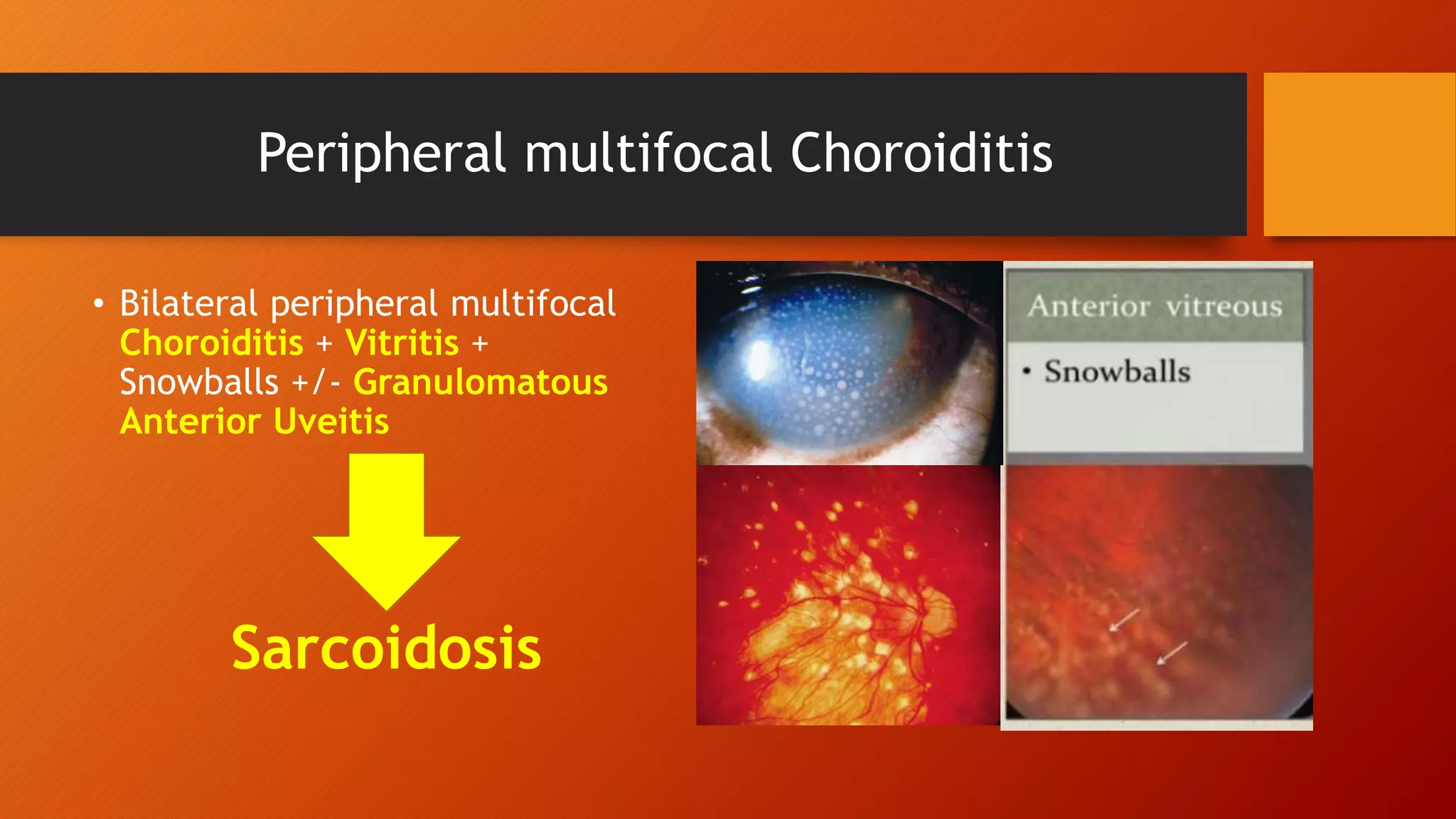 Approach to posterior uveitis final modified | PPTX