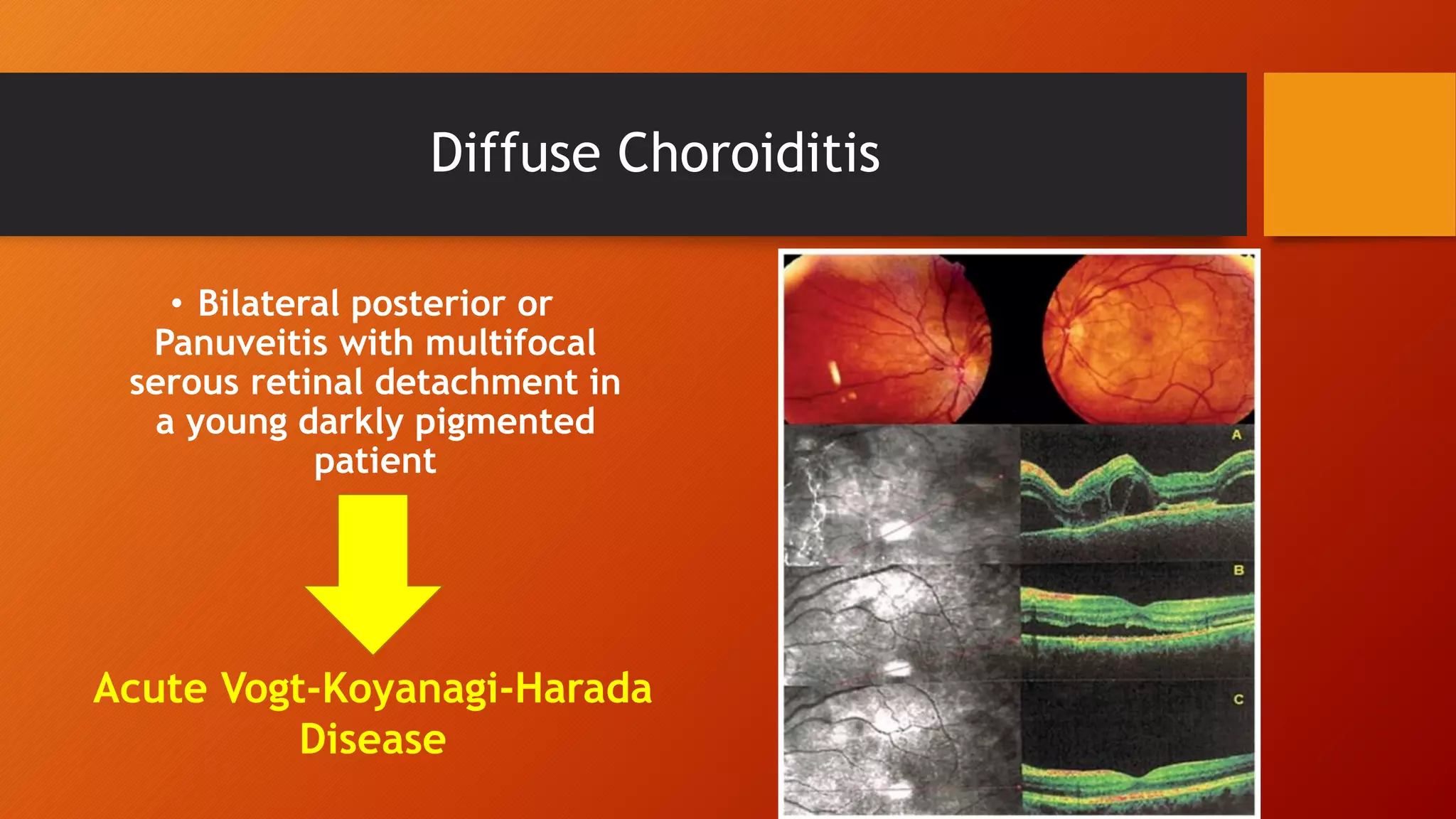 Approach to posterior uveitis final modified | PPTX