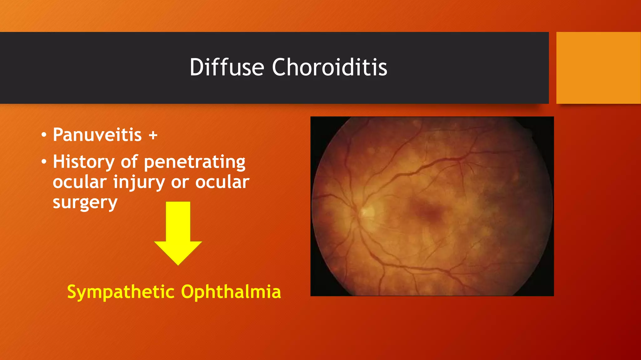 Approach to posterior uveitis final modified | PPTX