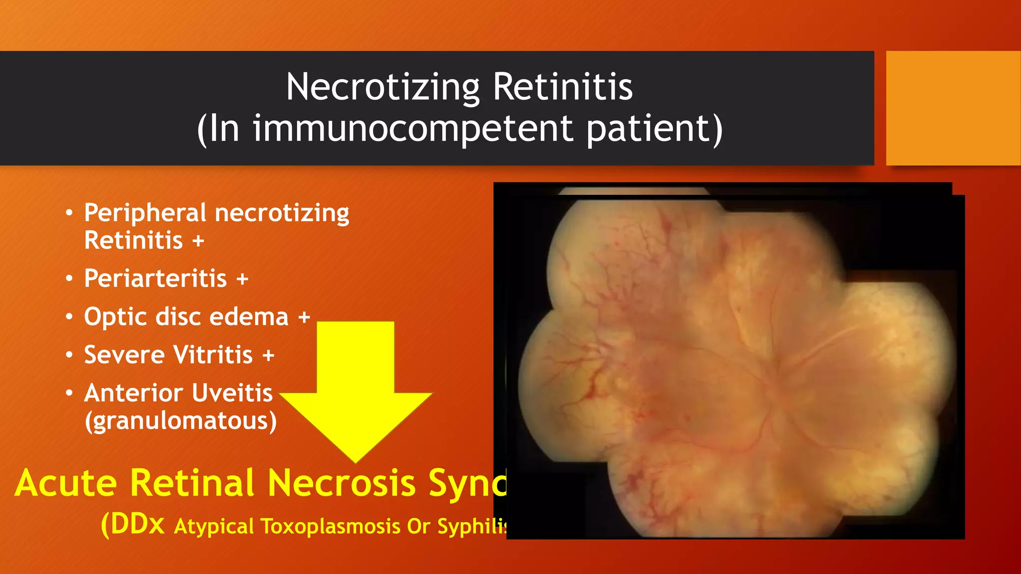 Approach to posterior uveitis final modified | PPTX