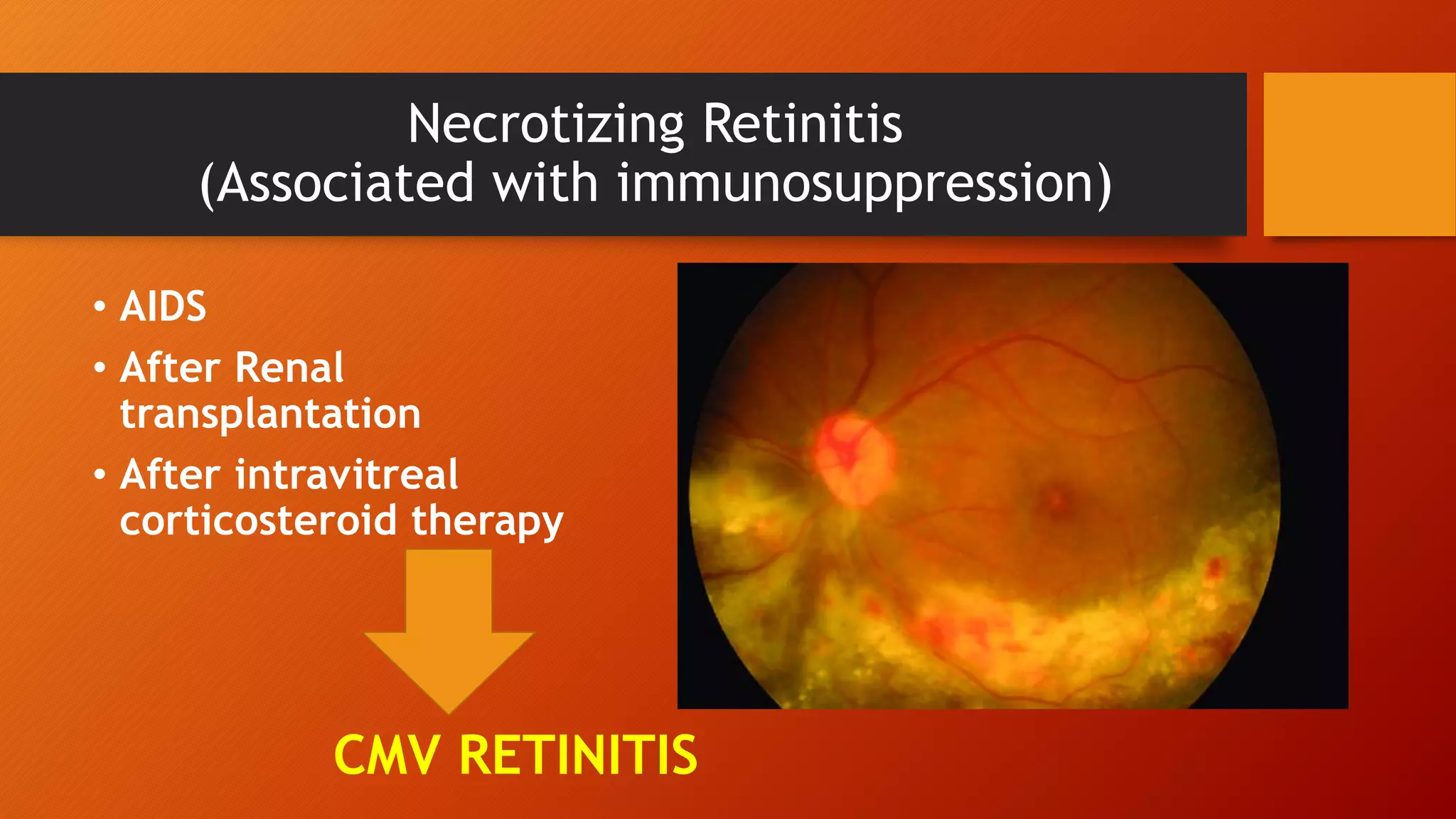 Approach to posterior uveitis final modified | PPTX