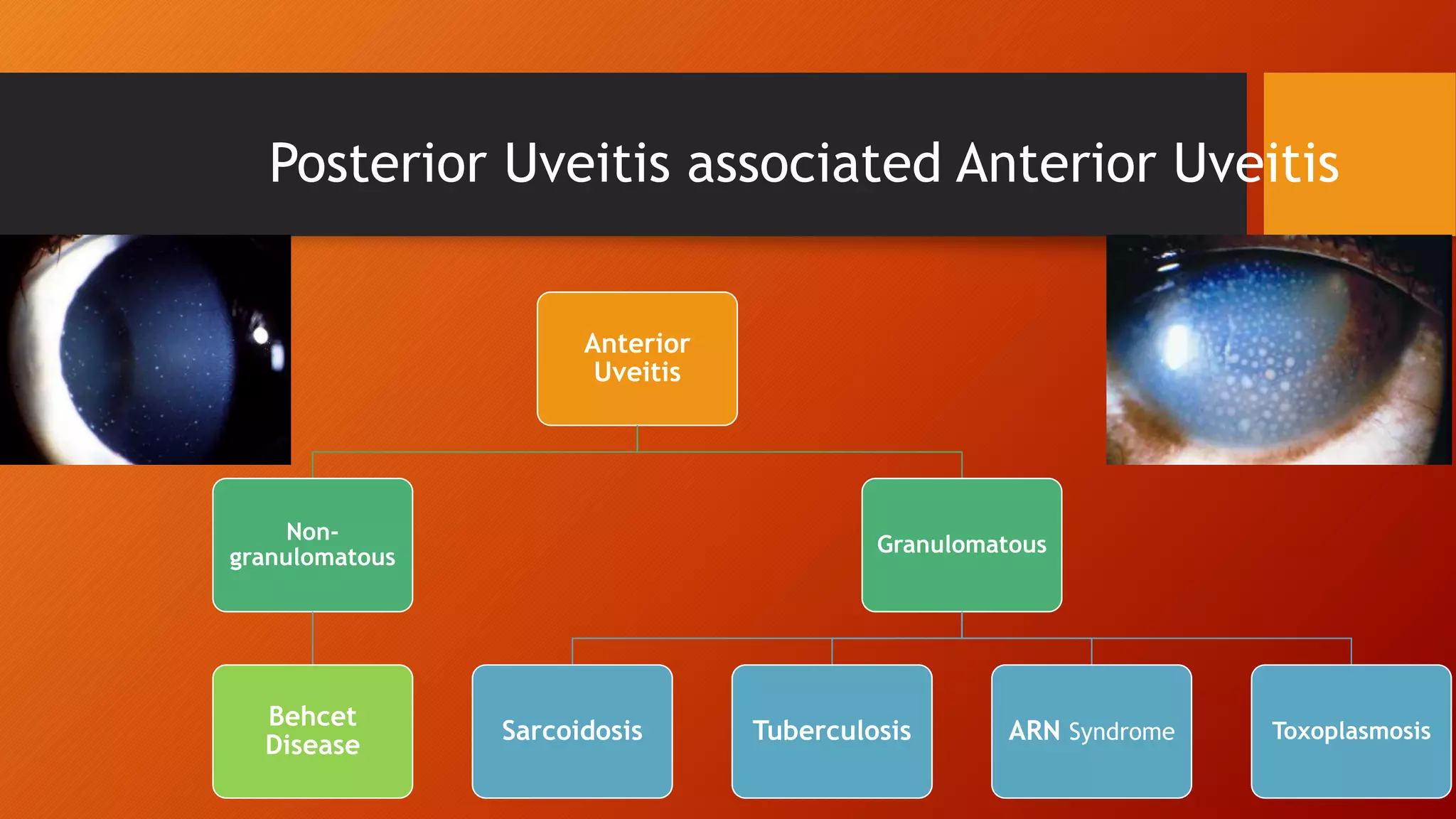 Approach to posterior uveitis final modified | PPTX
