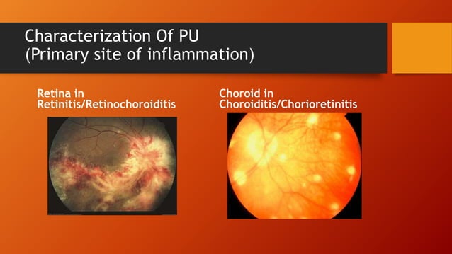 Approach to posterior uveitis final modified | PPTX | Infectious ...