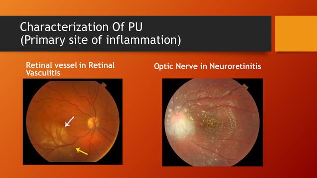 Approach to posterior uveitis final modified | PPTX | Infectious ...