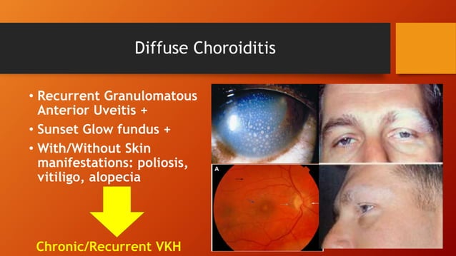 Approach to posterior uveitis final modified | PPTX | Infectious ...