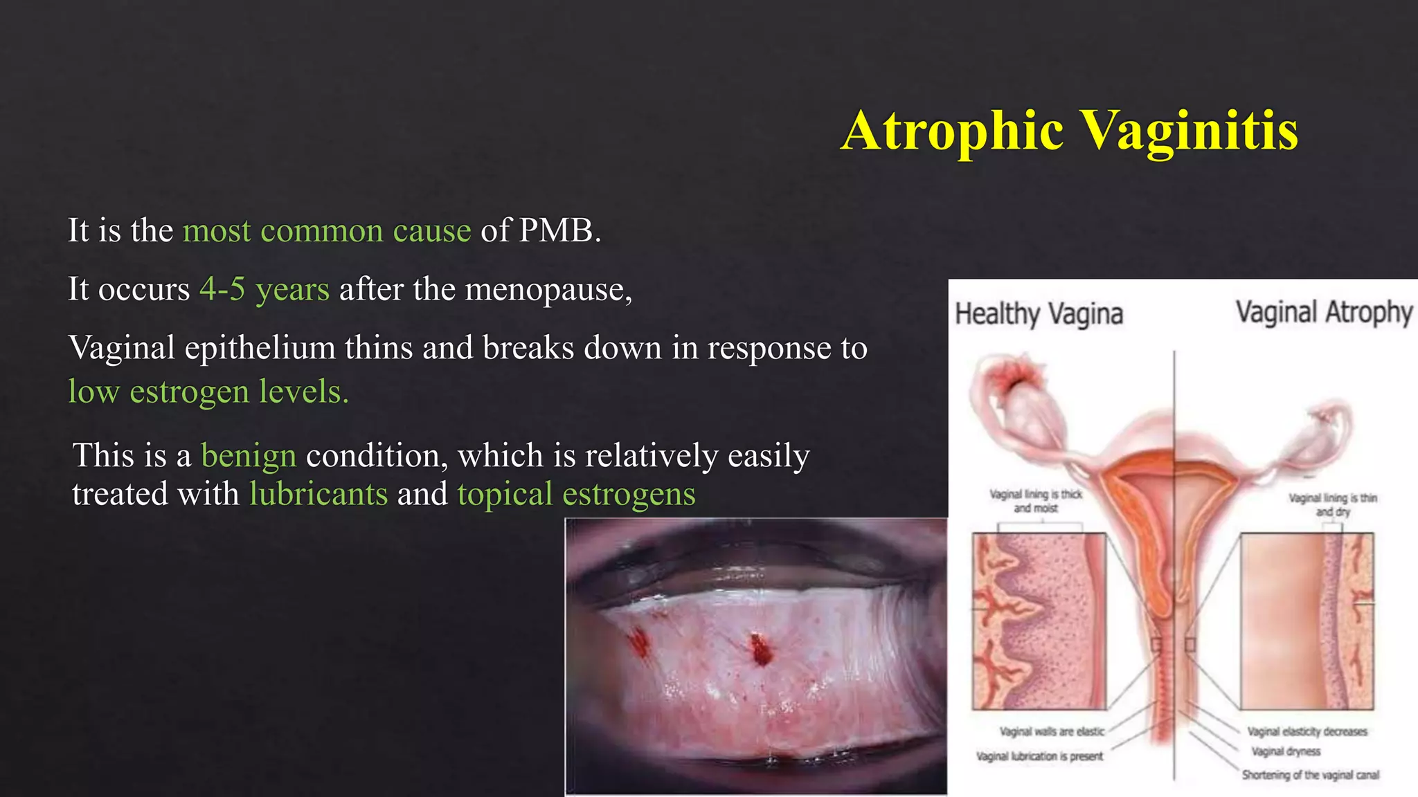 Approach to post menopausal bleeding | PPTX