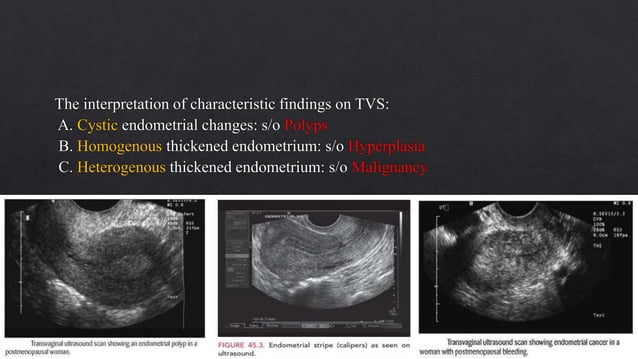 Approach to post menopausal bleeding | PPTX | Reproductive Health ...