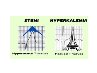 Approach to potassium disorder, causes, investigation, ecg changes ...