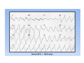 Approach to potassium disorder, causes, investigation, ecg changes ...
