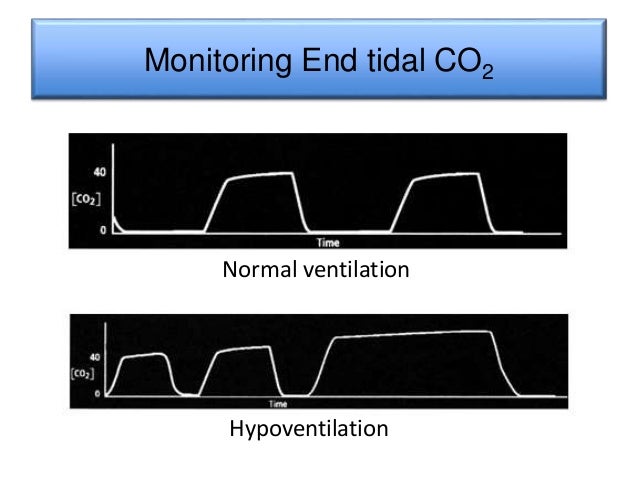 Approach to procedural sedation and analgesia