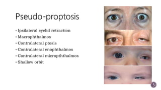 Approach to proptosis | PPT