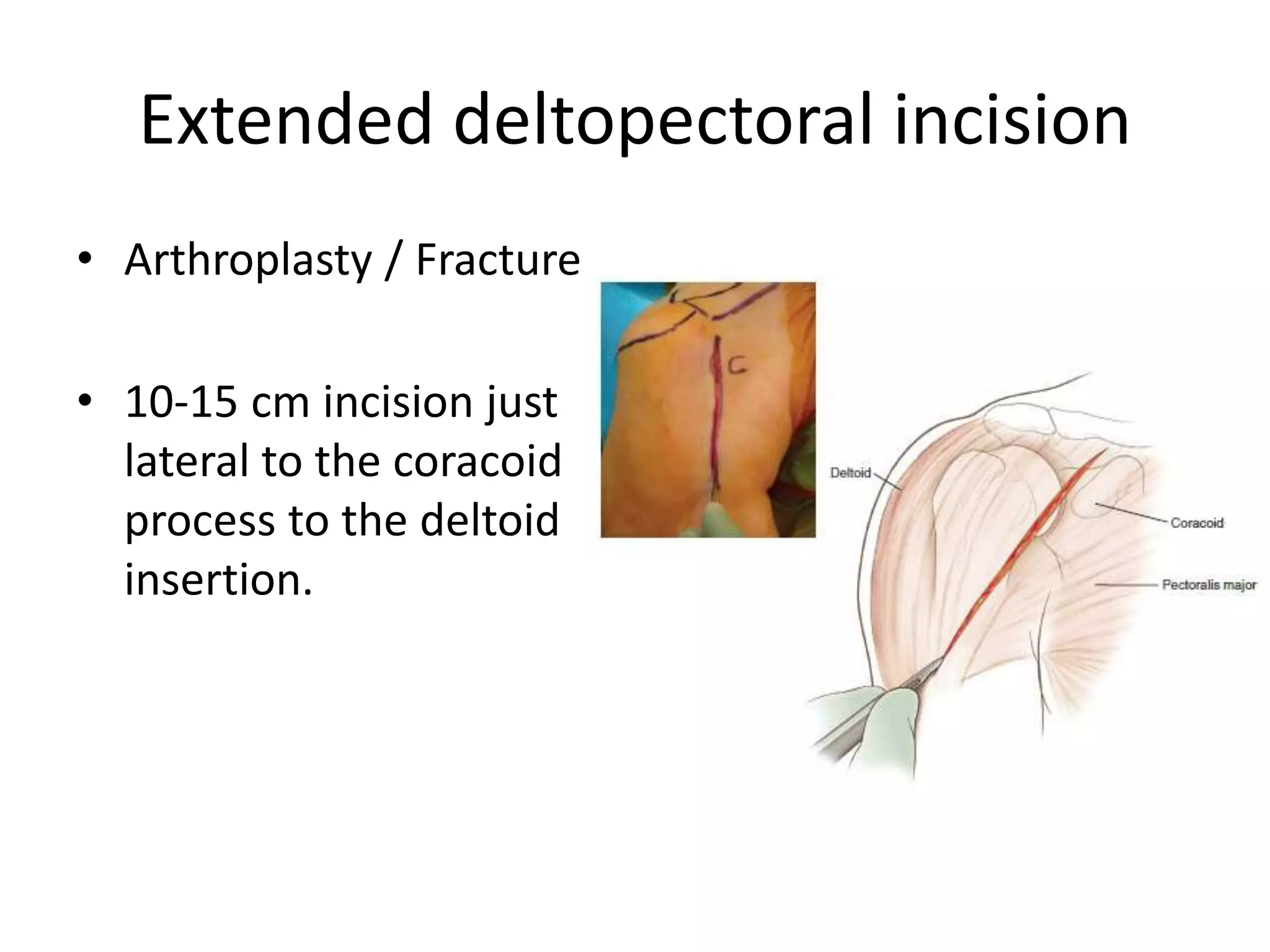 Approach to proximal arm | PPTX