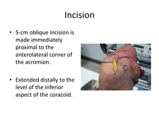 Approach to proximal arm | PPTX
