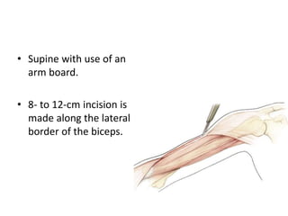 Approach to proximal arm | PPTX