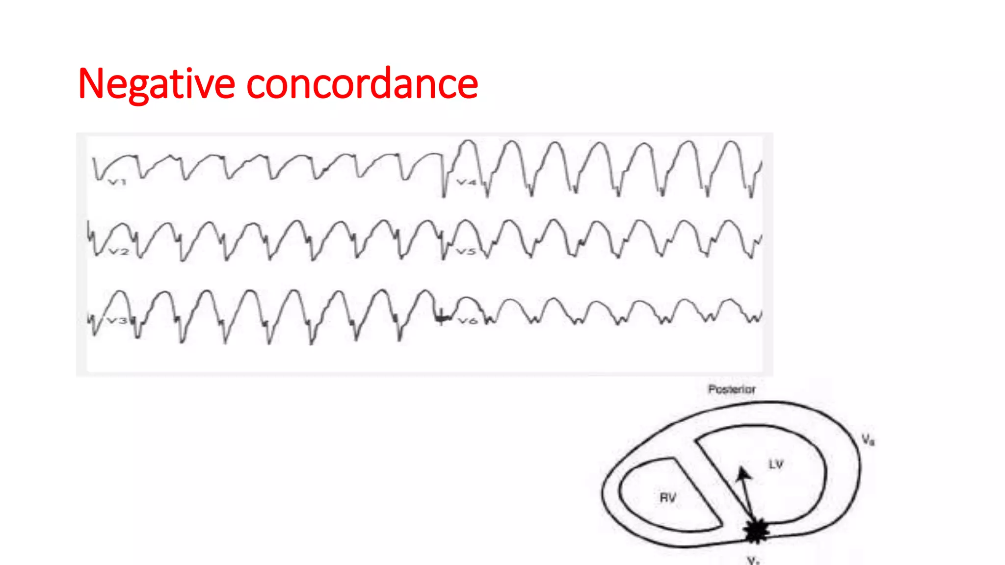 Approach to qrs wide complex tachycardias copy | PPTX | Heart and ...