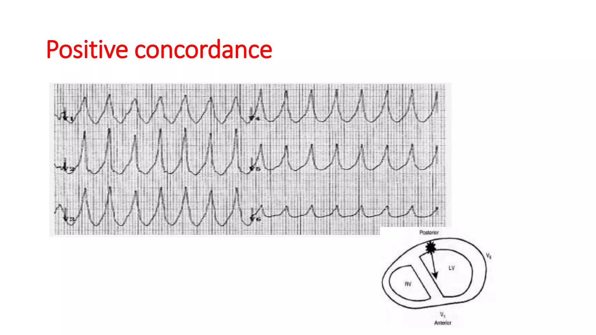 Approach to qrs wide complex tachycardias copy | PPTX | Heart and ...
