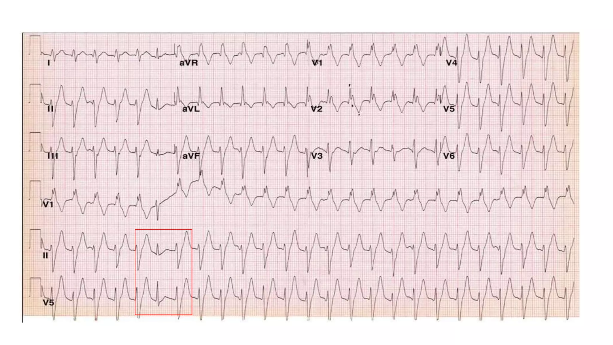 Approach to qrs wide complex tachycardias copy | PPTX | Heart and ...
