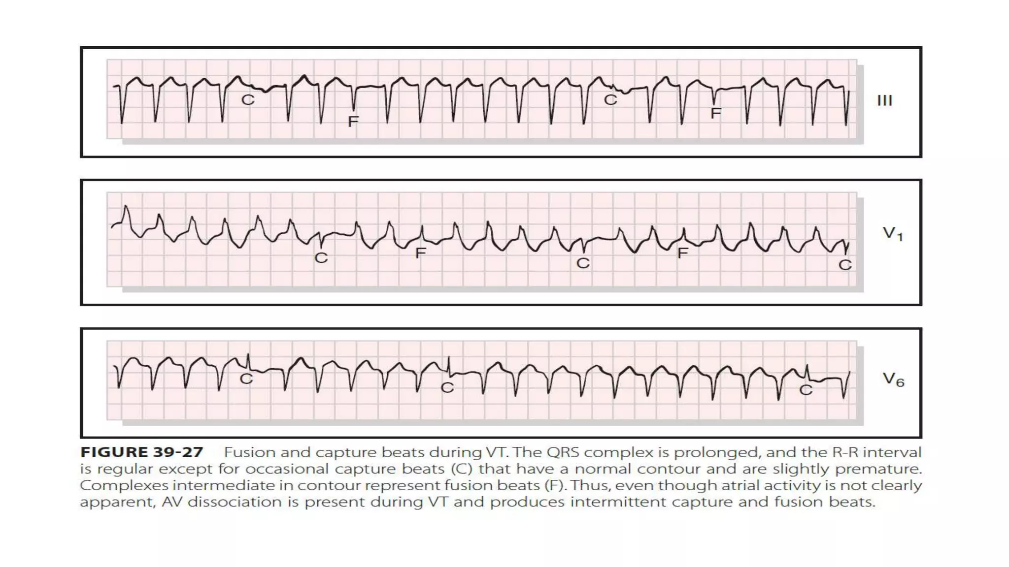 Approach to qrs wide complex tachycardias copy | PPTX | Heart and ...