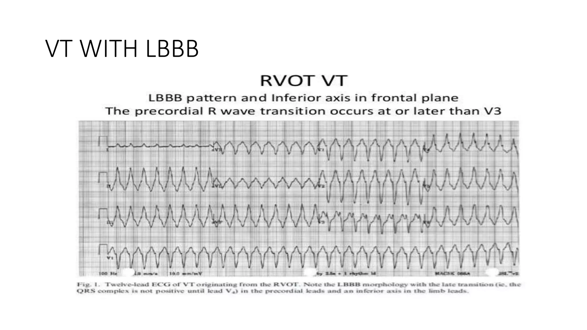 Approach to qrs wide complex tachycardias copy | PPTX | Heart and ...