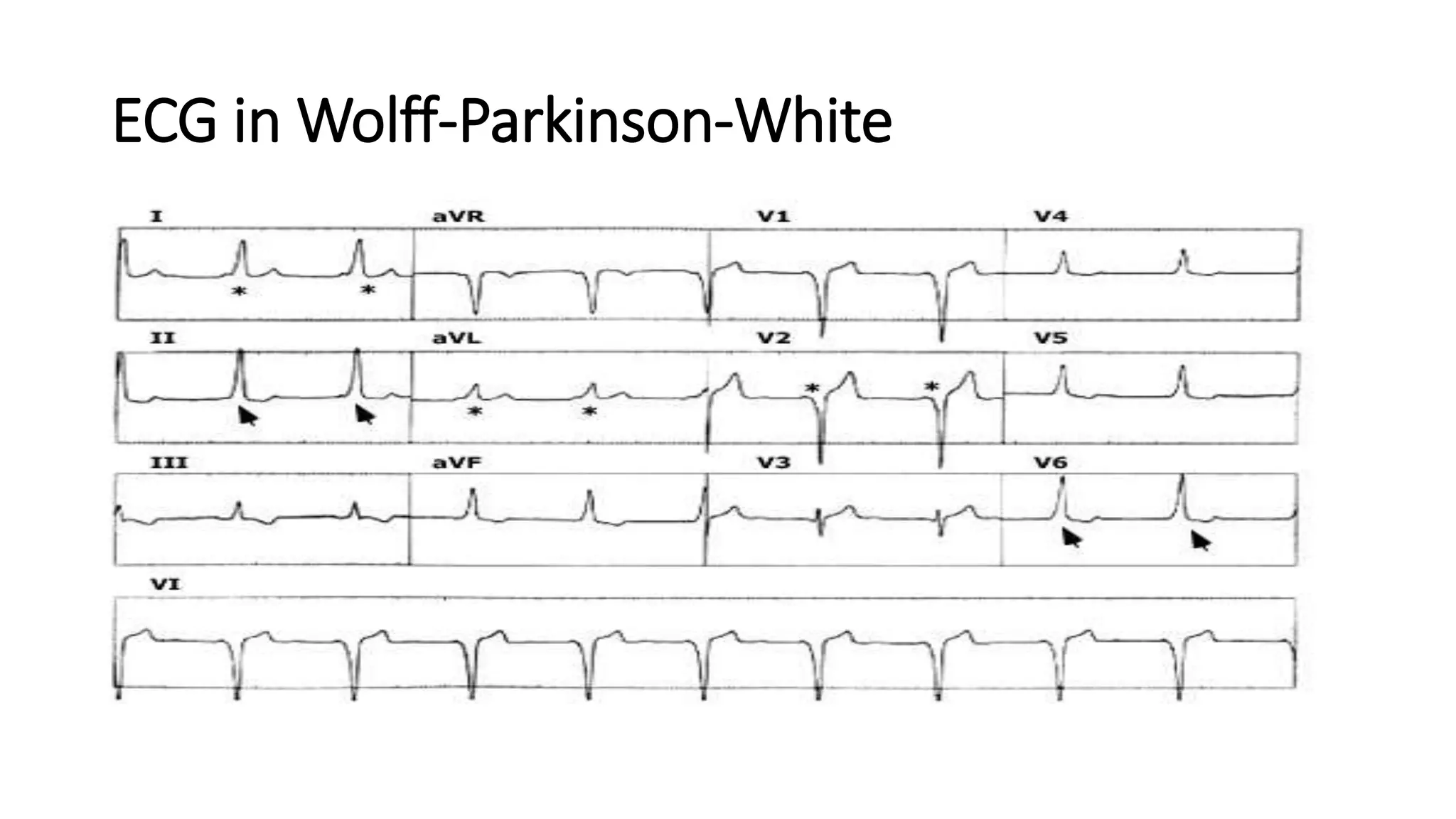 Approach to qrs wide complex tachycardias copy | PPTX | Heart and ...