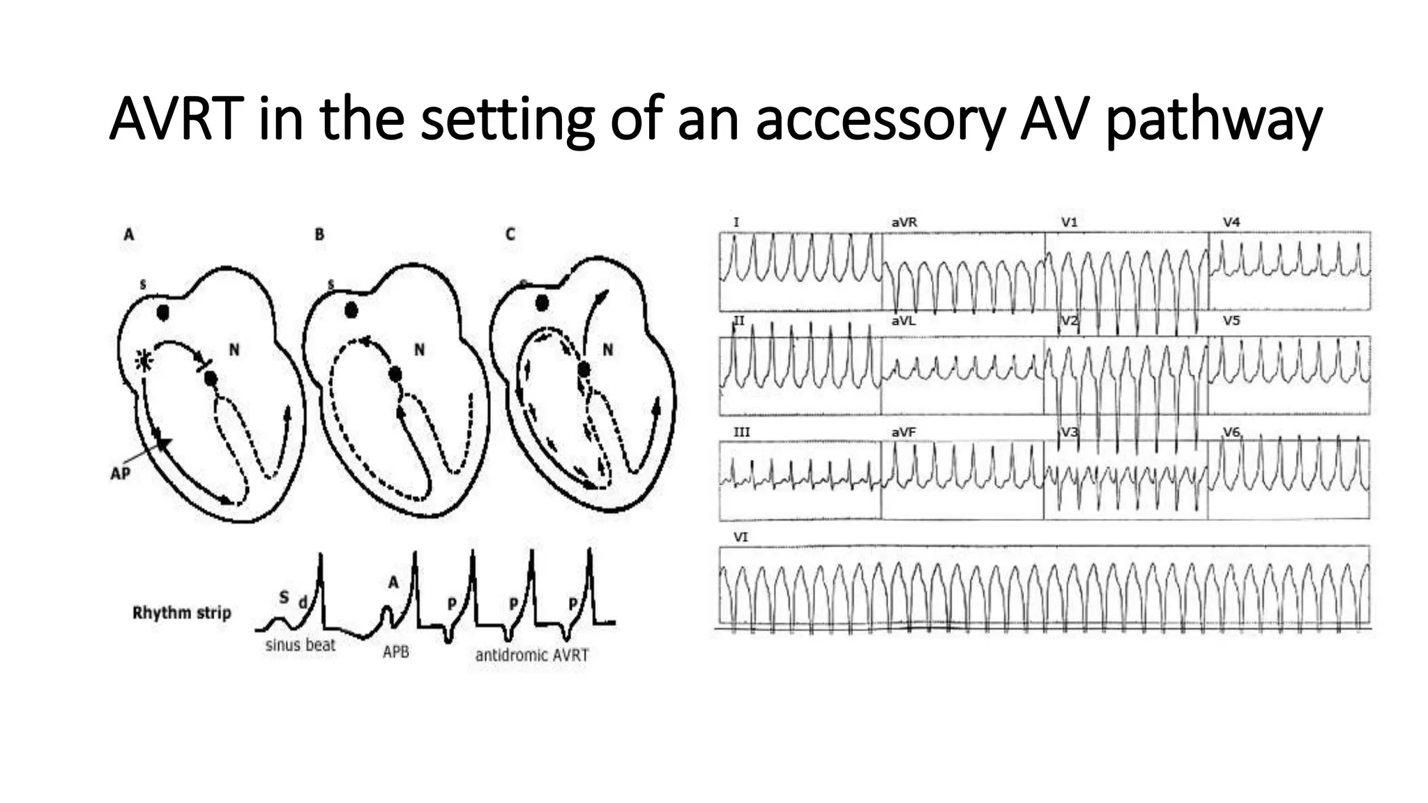 Approach to qrs wide complex tachycardias copy | PPTX | Heart and ...