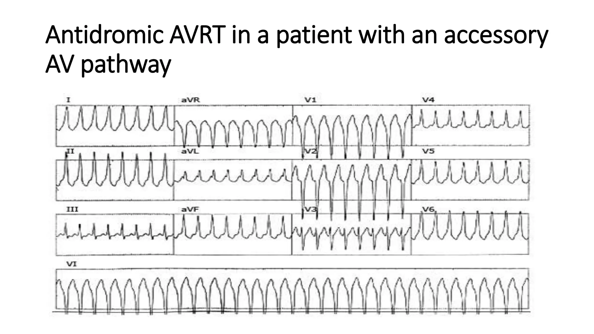 Approach to qrs wide complex tachycardias copy | PPTX | Heart and ...