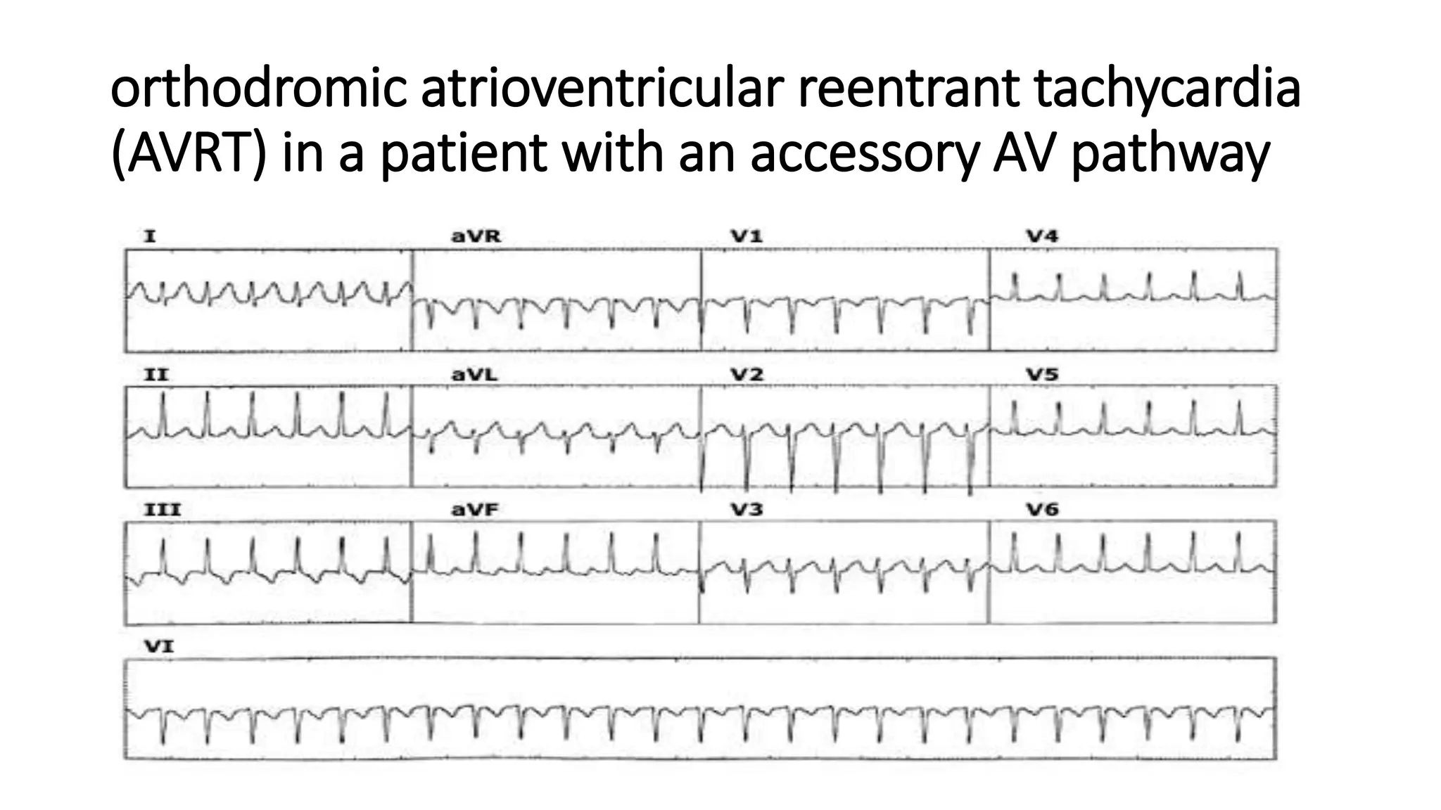 Approach to qrs wide complex tachycardias copy | PPTX | Heart and ...