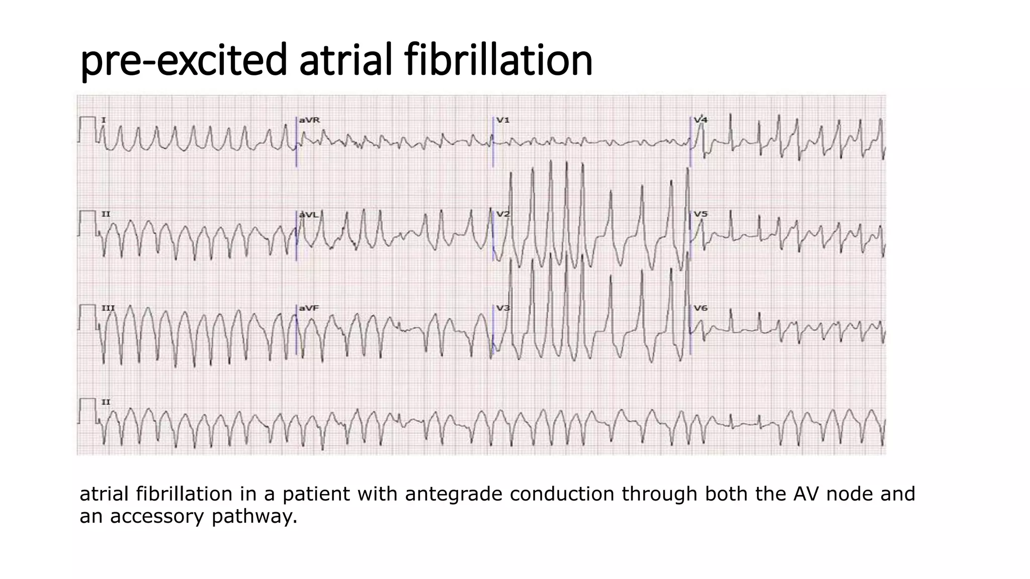 Approach to qrs wide complex tachycardias copy | PPTX | Heart and ...