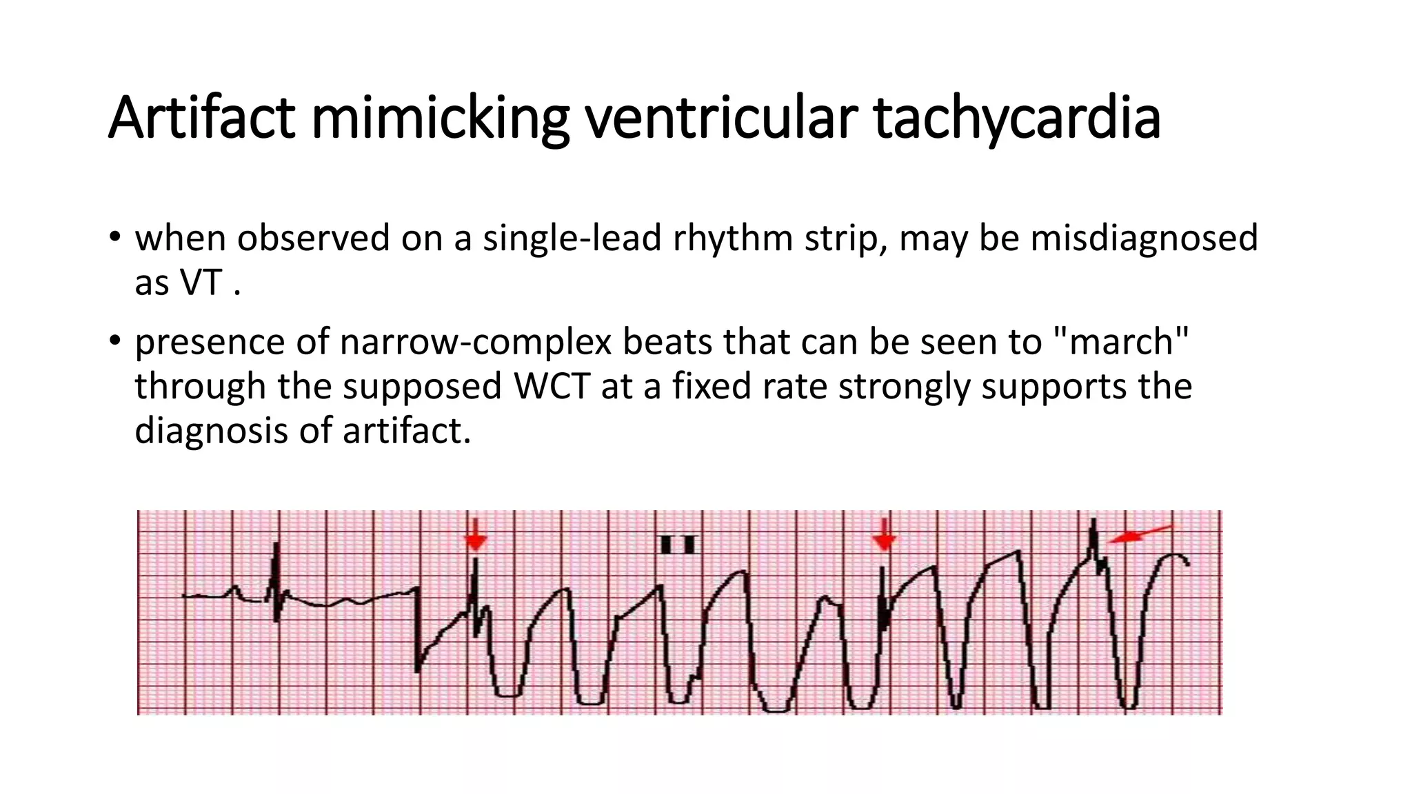 Approach to qrs wide complex tachycardias copy | PPTX | Heart and ...