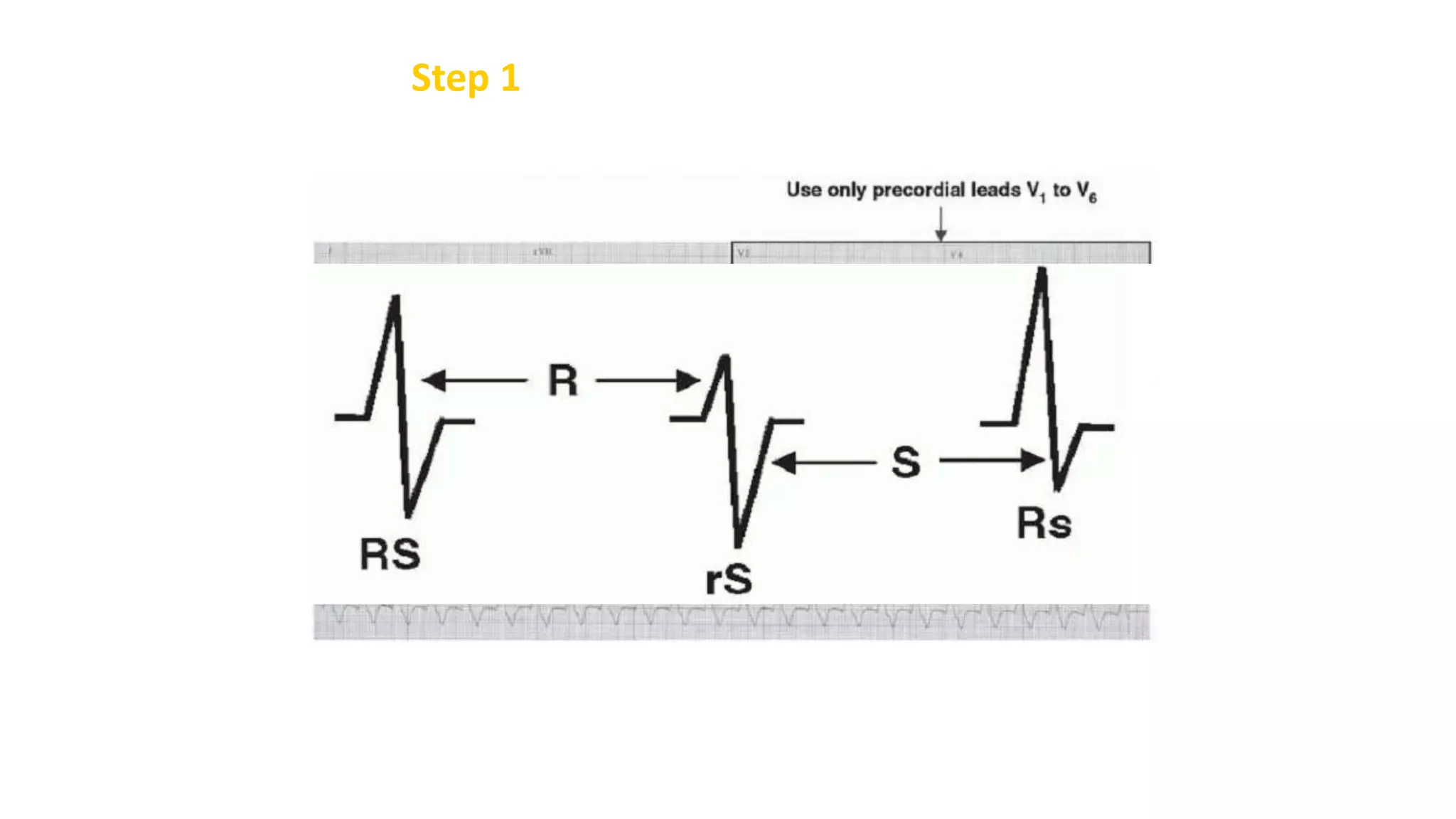 Approach to qrs wide complex tachycardias copy | PPTX | Heart and ...