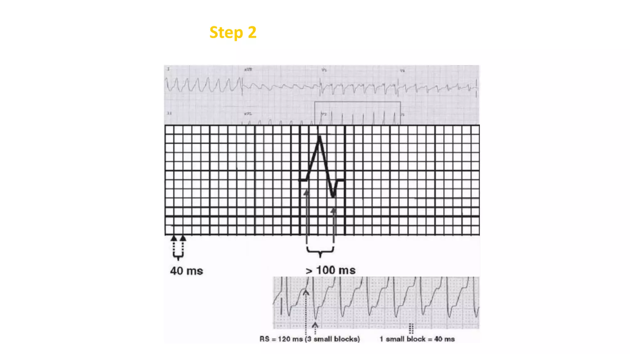 Approach to qrs wide complex tachycardias copy | PPTX | Heart and ...