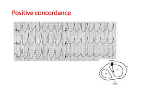 Approach to qrs wide complex tachycardias copy | PPTX