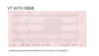 Approach to qrs wide complex tachycardias copy | PPTX