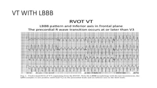 Approach to qrs wide complex tachycardias copy | PPTX