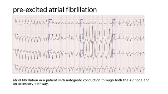 Approach to qrs wide complex tachycardias copy | PPTX | Heart and ...