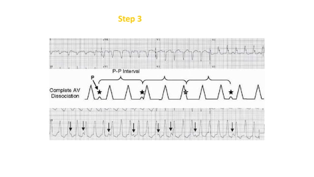 Approach to qrs wide complex tachycardias copy | PPTX | Heart and ...