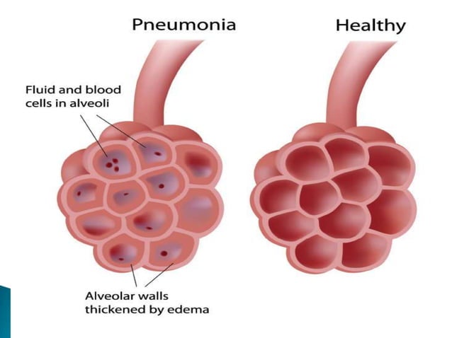 Approach to recurrent pneumonia | PPT