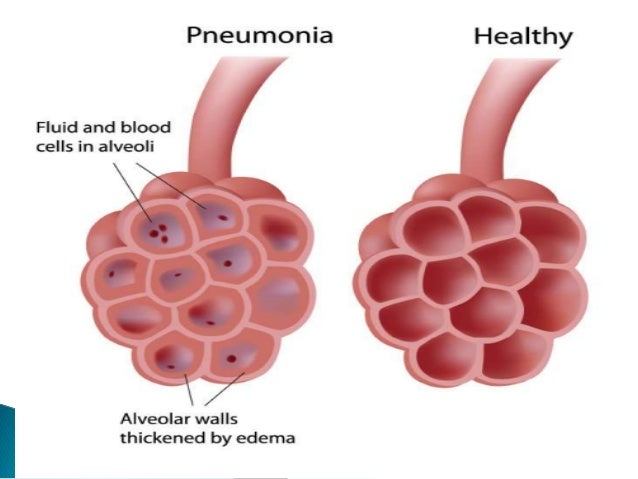 Approach to recurrent pneumonia